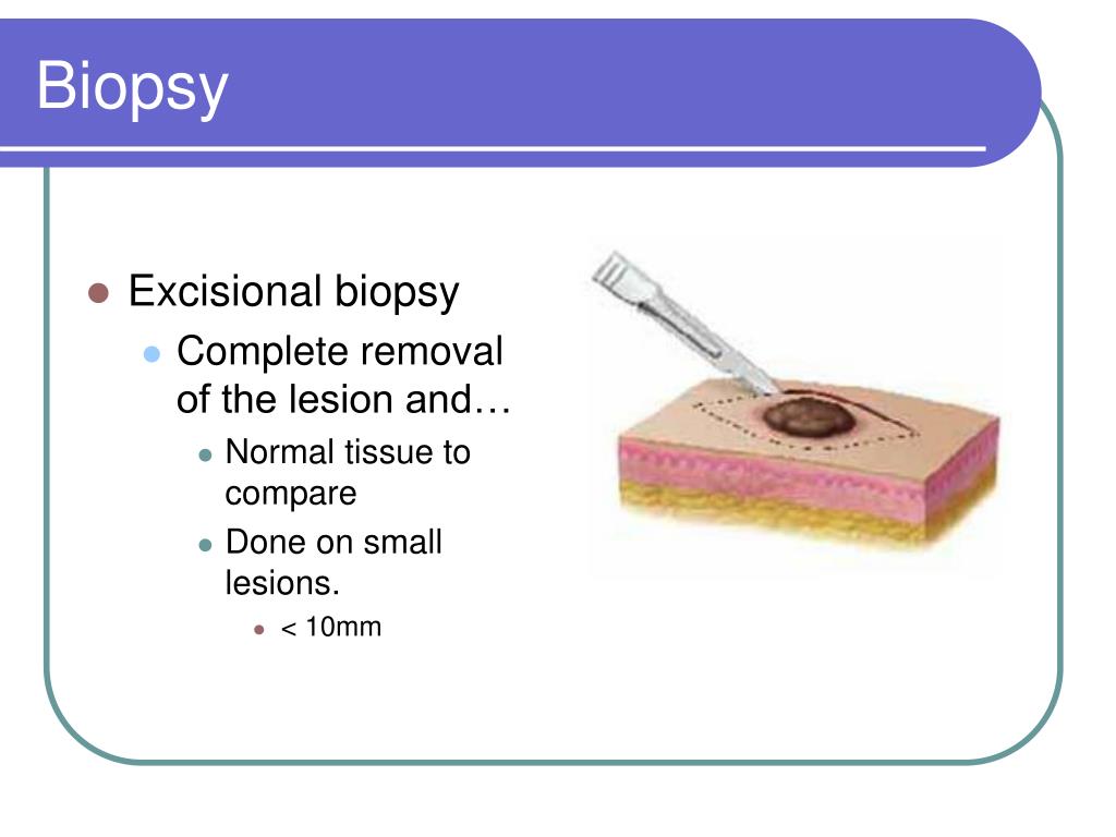 Definition Of Excisional Biopsy Definition Hjo