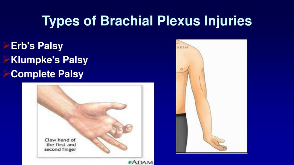 Brachial Plexus Injury In Newborn Ppt