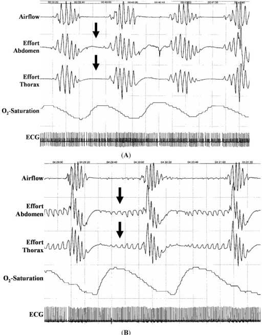 Central Sleep Apnea Vs Obstructive