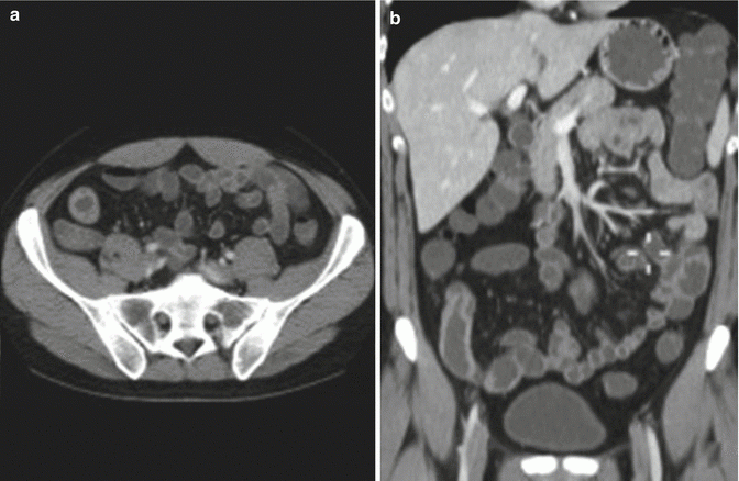 Gastro Intestinal Tract Radiology Obgyn Key