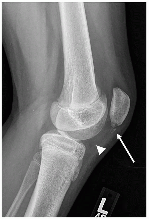 Pediatric Musculoskeletal System Obgyn Key