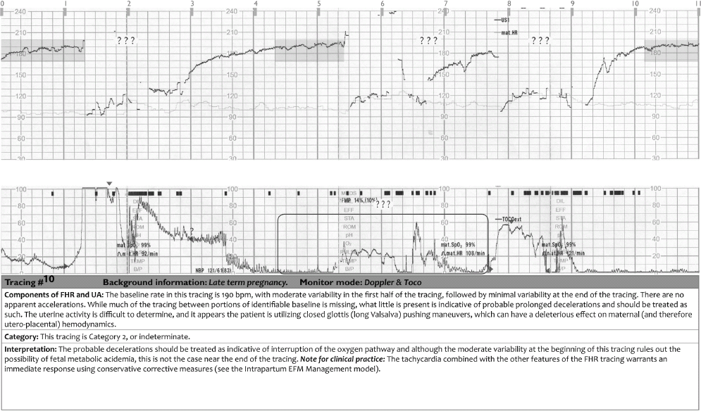 Intrapartum Electronic Fetal Monitoring Obgyn Key