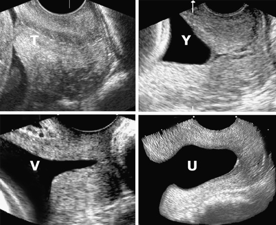 Ultrasound Evaluation Of The Gravid Cervix Obgyn Key