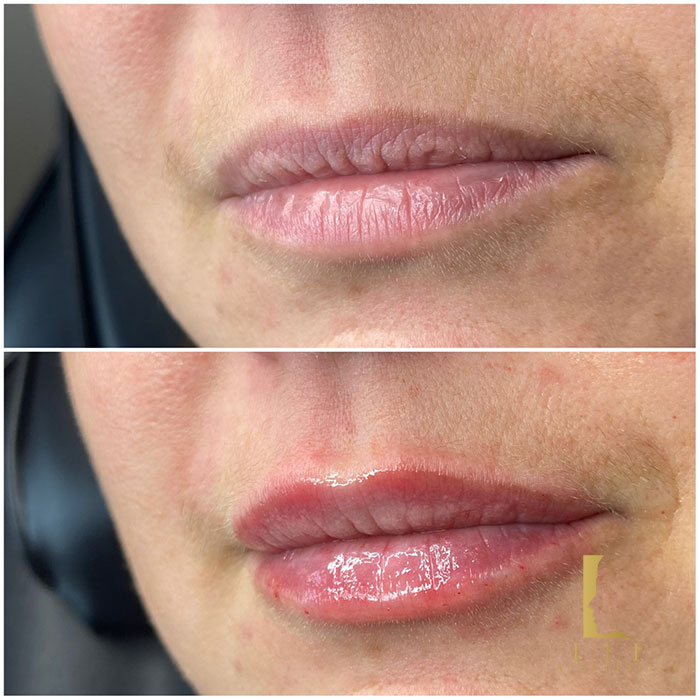 Does 1ml Lip Filler Make A Difference