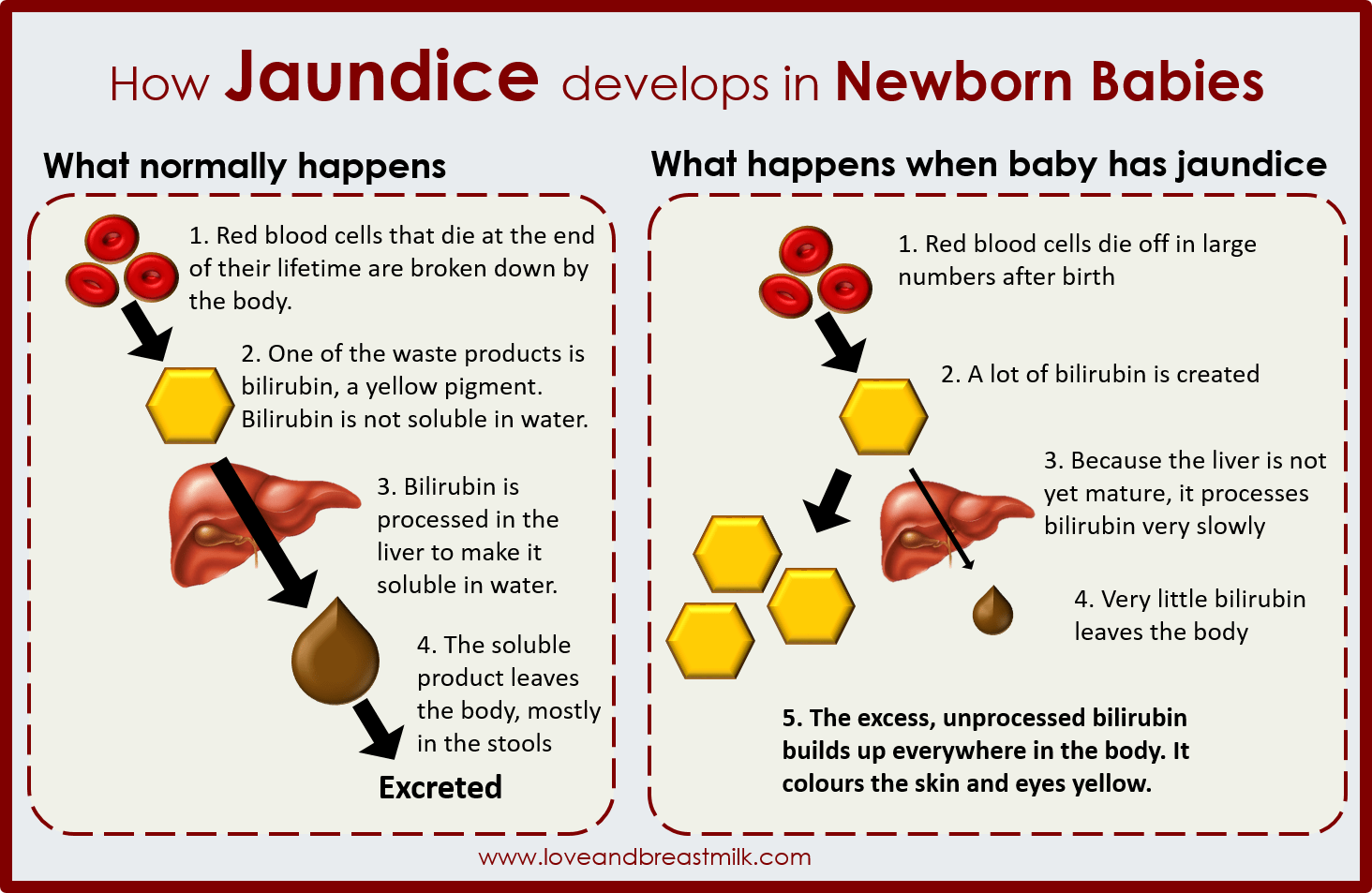 Jaundice In Breast Fed Babies Love And Breast Milk