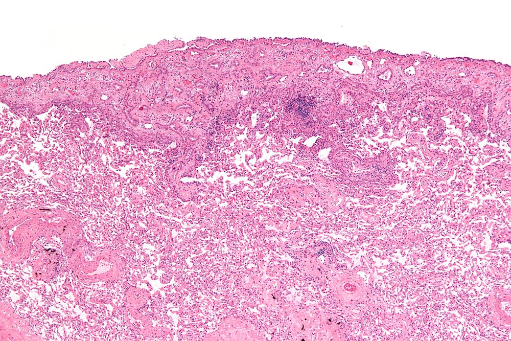 Malignant Mesothelioma Libre Pathology 2022 2022e Jurnal