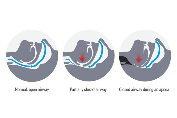 Central Sleep Apnea Vs Obstructive