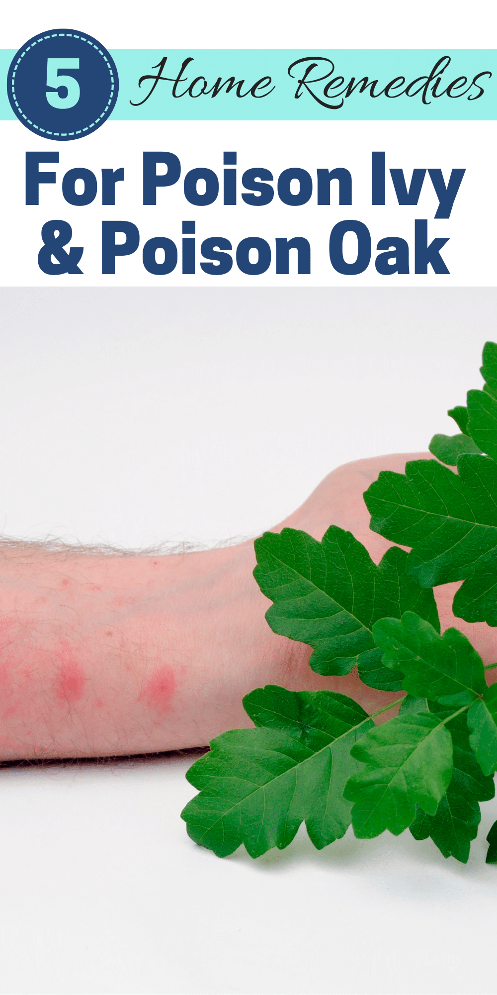 5 Home Remedies For Poison Oak And Poison Ivy Midwest Modern Momma