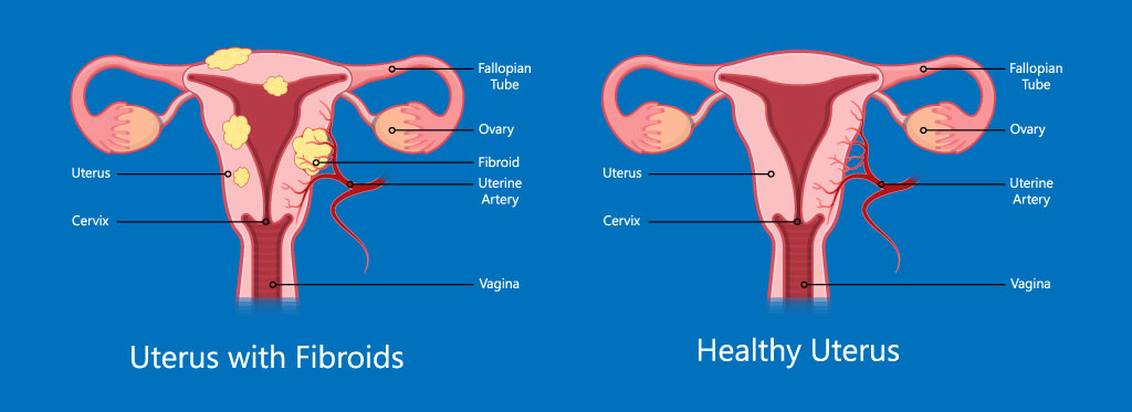 Can Uterine Polyps Cause Pain Cares Healthy