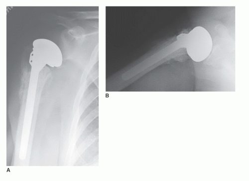 Arthroscopic Treatment Of The Arthritic Shoulder Musculoskeletal Key