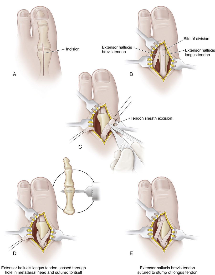 20 Split Anterior Tibialis Tendon Transfer Musculoskeletal Key