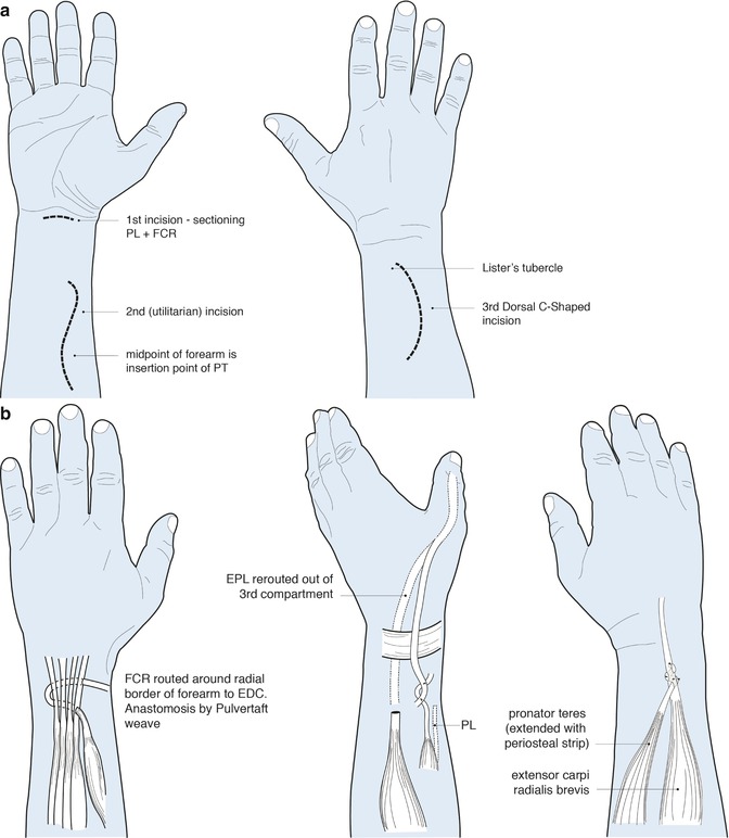 Radial Nerve Palsy Tendon Transfers Fd0