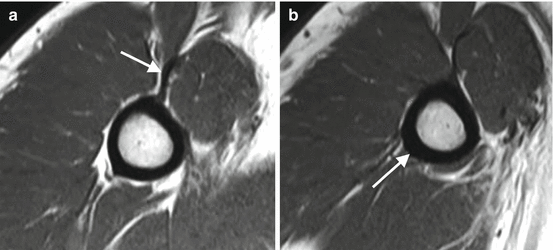 Pectoralis Major Injury Musculoskeletal Key