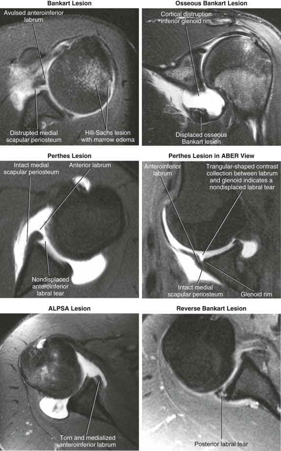 Anterior Shoulder Instability Musculoskeletal Key