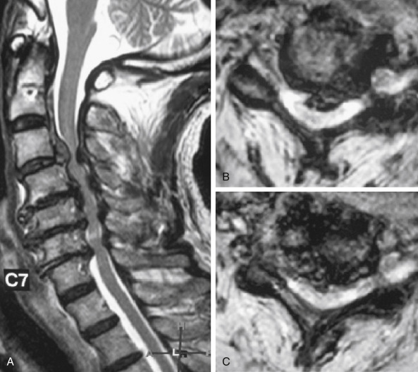 Cervical Degenerative Disk Disease Musculoskeletal Key