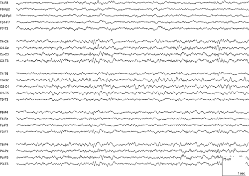 Positive Occipital Sharp Transients Of Sleep Neupsy Key