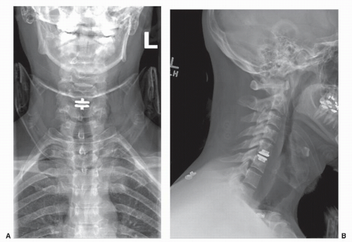 Cervical Degenerative Disk Disease Overview And Epidemiology Neupsy Key