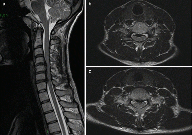 Diagnostic Imaging In The Degenerative Diseases Of The Cervical Spine