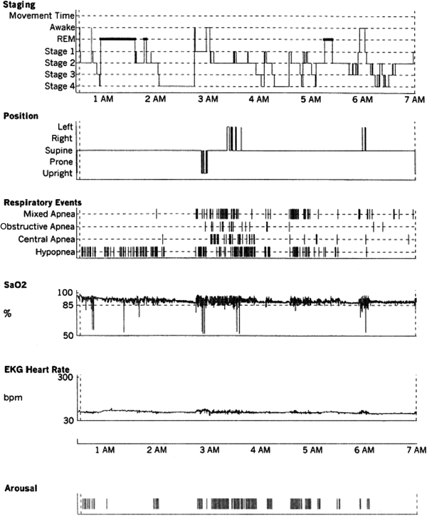 Sleep Breathing And Neurologic Disorders Neupsy Key