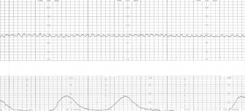 Intrapartum Electronic Fetal Monitoring Nurse Key