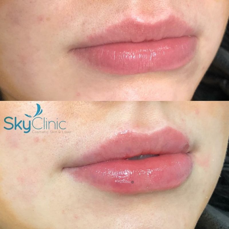 05 Ml Lip Filler Before And After