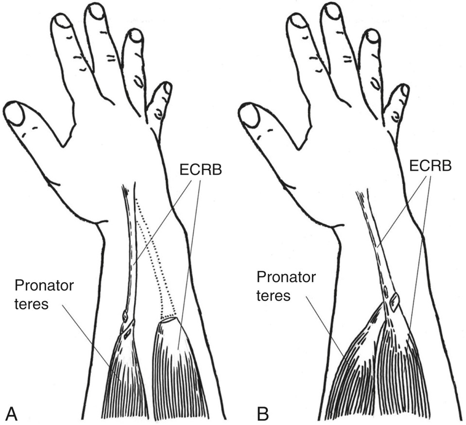 Tendon Transfers Plastic Surgery Key