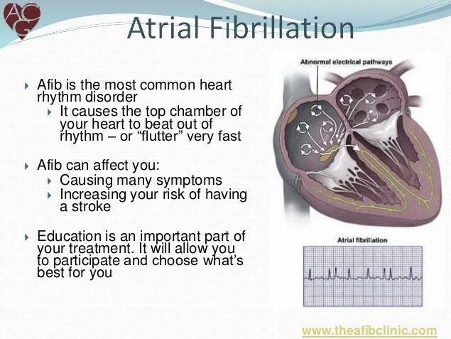 Symptoms Of Atrial Fibrillation Pt Master Guide