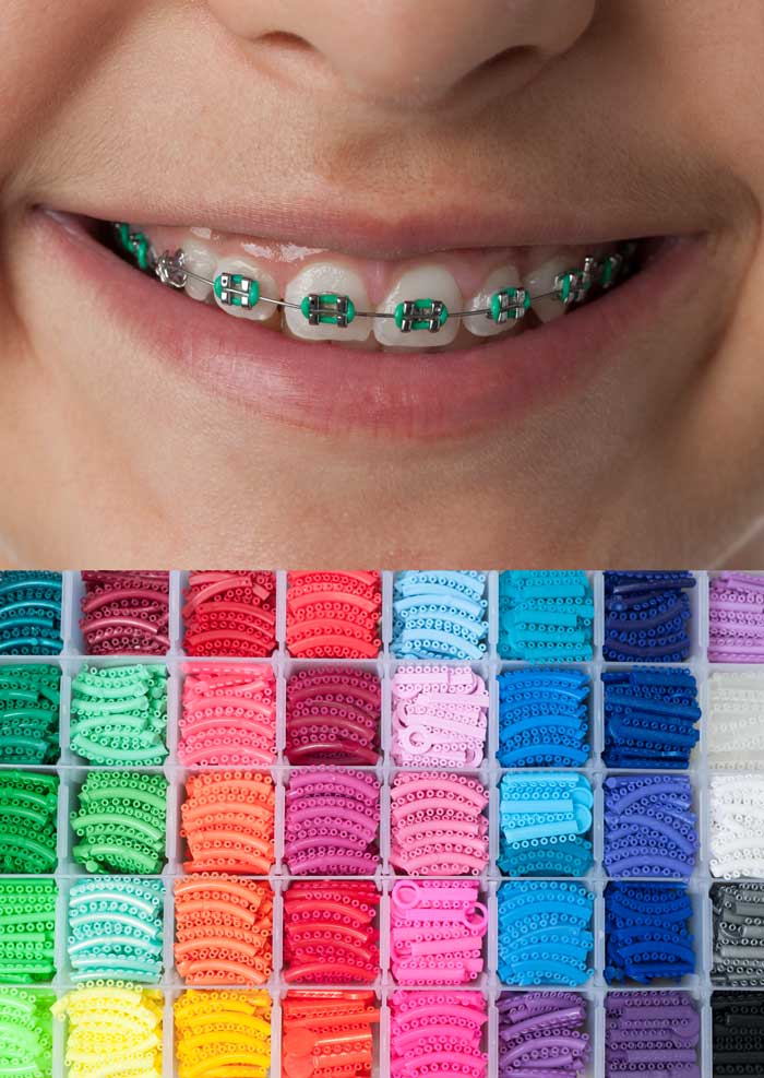 The Best Best Color For Braces Bands References