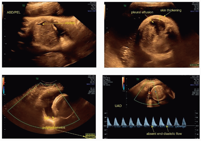 Second And Third Trimester Pregnancy Radiology Key