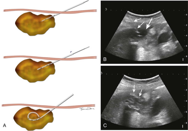 Abdominal Abscess Radiology Key