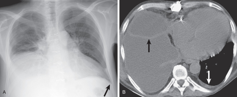 Pleural Effusion Radiology Key