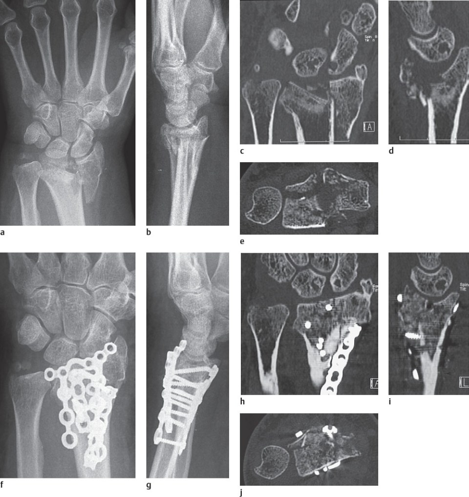 17 Trauma Of The Distal Forearm Radiology Key