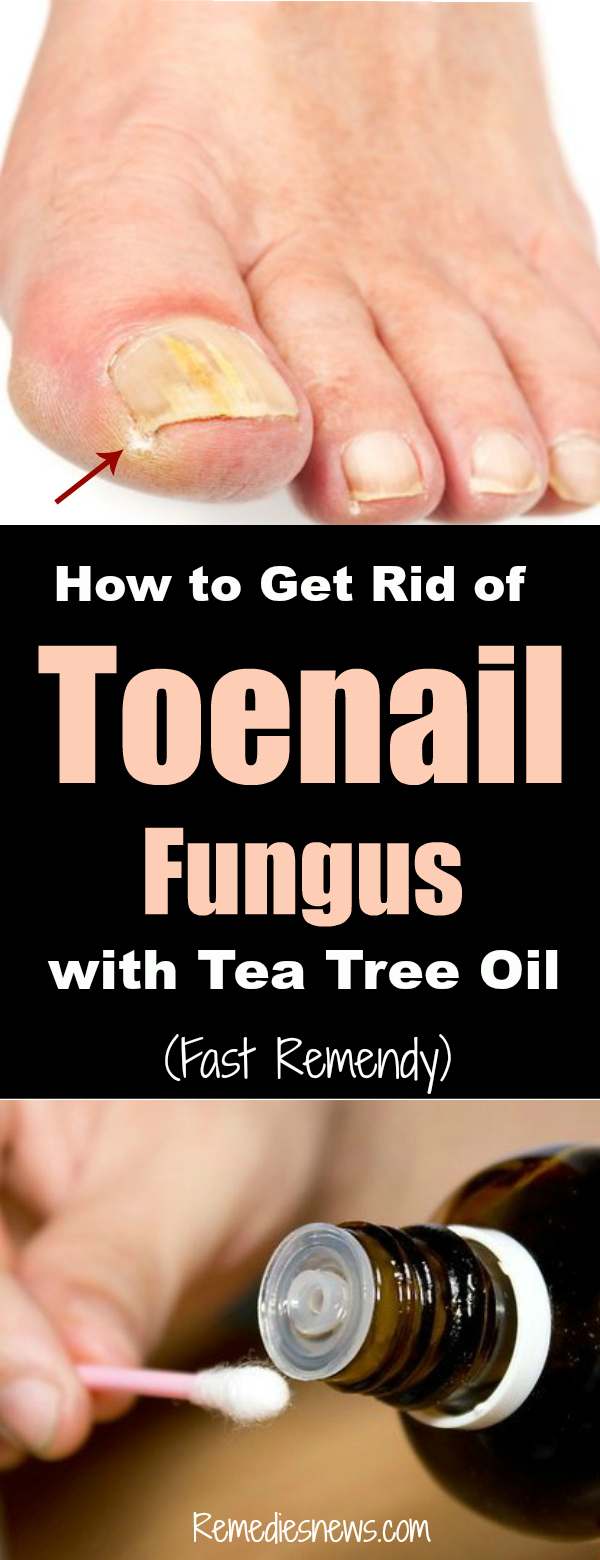 How To Get Rid Of Toenail Fungus With Tea Tree Oil Fast Remedy