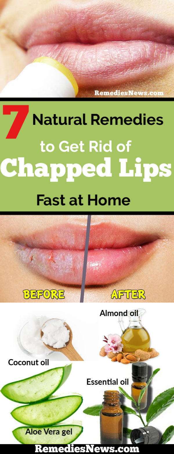 7 Natural Remedies To Get Rid Of Chapped Lips Fast At Home