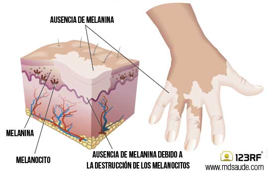 VitÍligo Causas Síntomas Y Tratamiento Mdsaúde