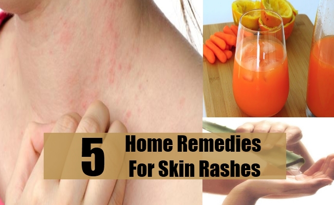 5 Home Remedies For Skin Rashes Natural Cure And Herbal Treatment For