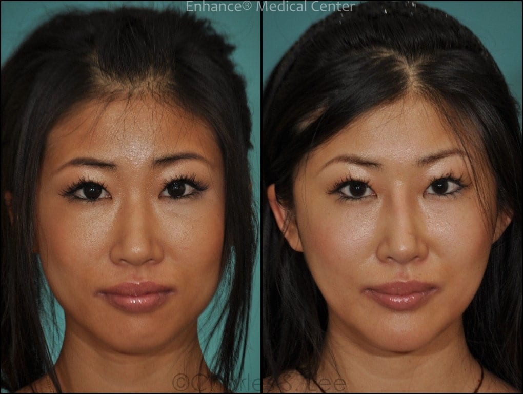 Incredible Non Surgical Nose Job Before And After Asian 2022 My Reff