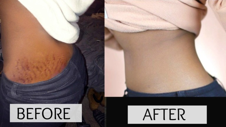 Stretch Marks Removal Remedies 7 Effective Ones