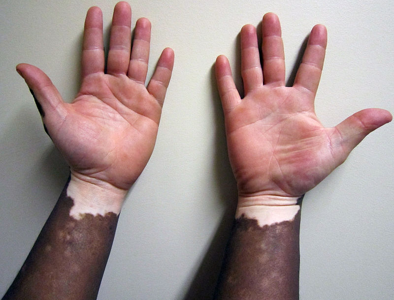 Difference Between Albinism And Vitiligo Compare The Difference