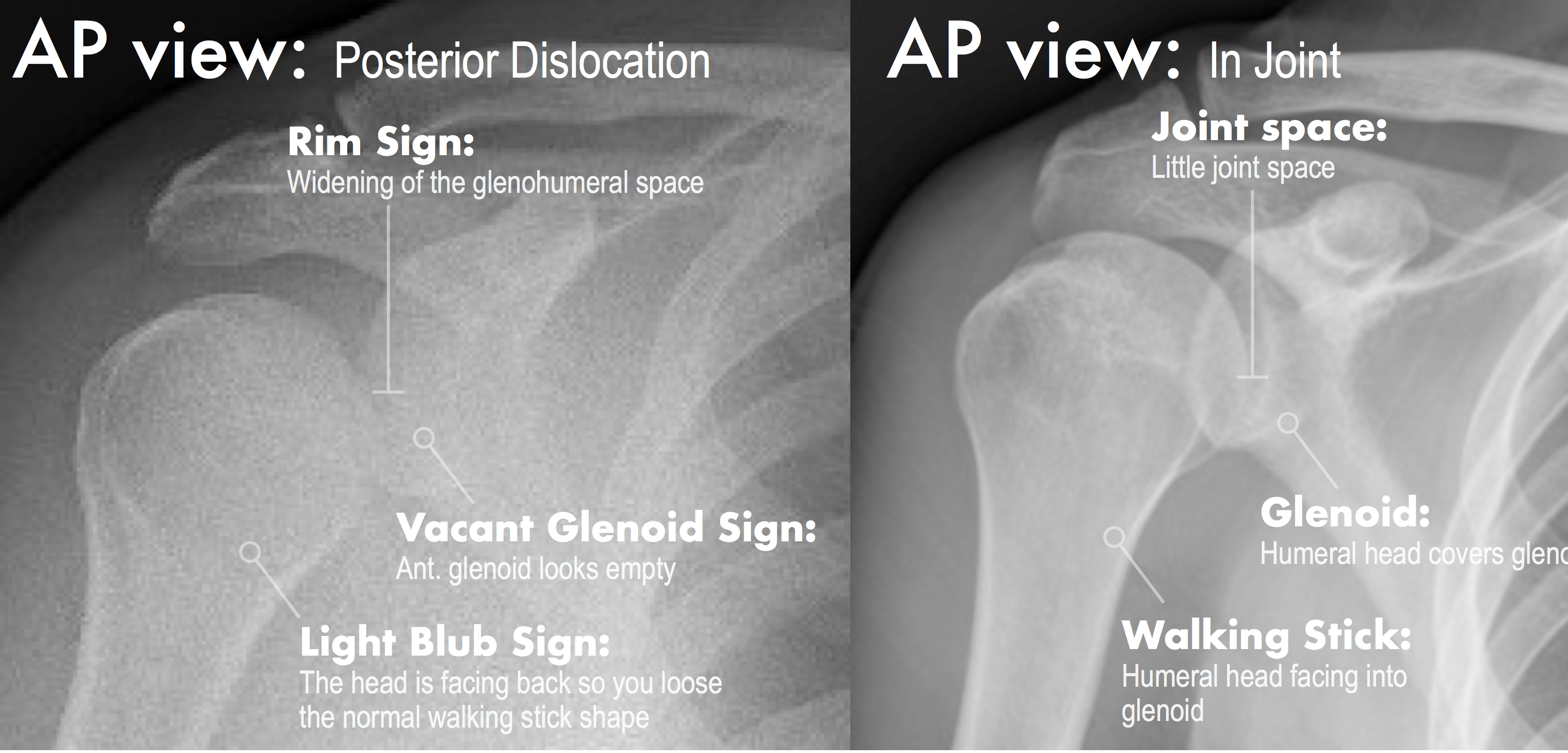 Posterior Shoulder Dislocation Uk