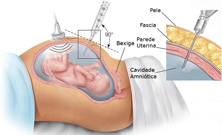 O Que é Amniocentese Fetalmed Medicina Fetal Em Curitiba