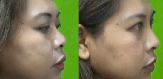 Incredible Non Surgical Nose Job Before And After Asian 2022 My Reff