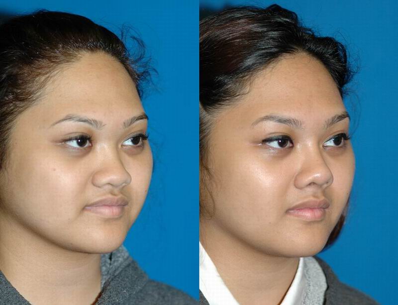 19 Nose Job Before After Asian Ideas My Reff