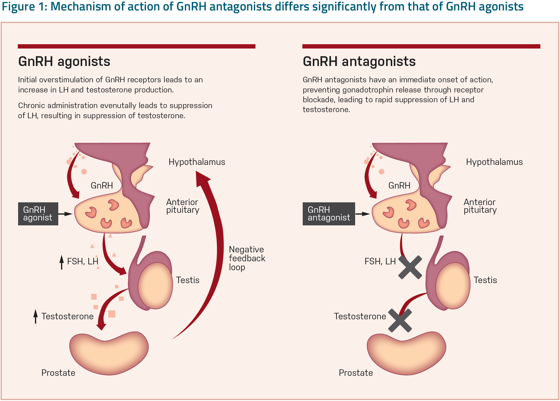 Adt Therapy For Prostate Cancer