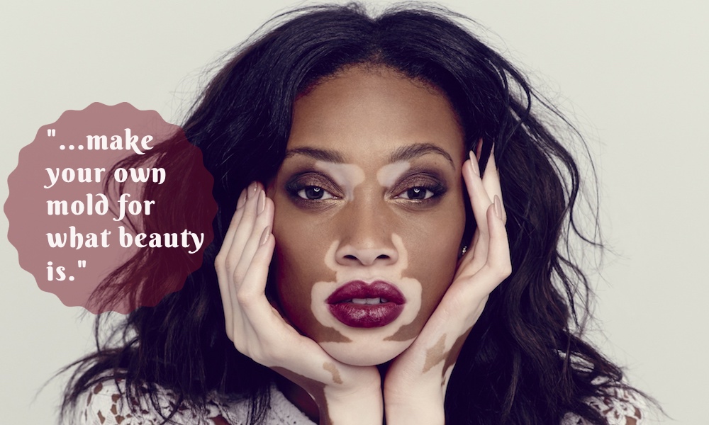 Top Model Winnie Harlow Says Living With Vitiligo Didnt Deter Her From