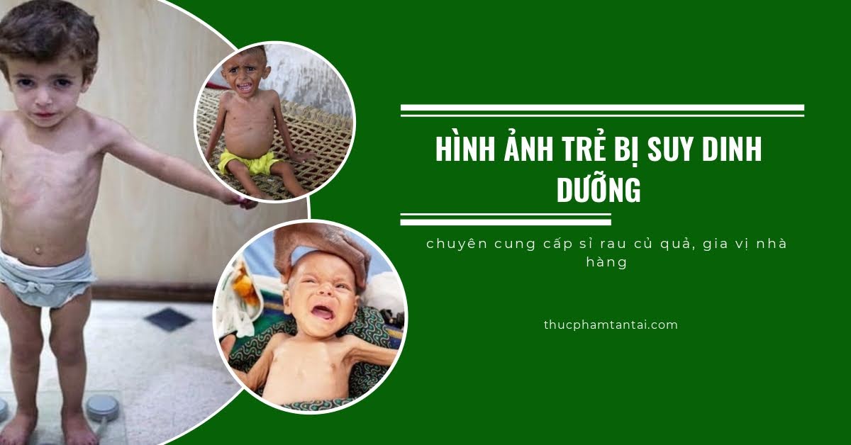 Dấu Hiệu Nhận Biết Suy Dinh Dưỡng ở Trẻ Thực Phẩm Tấn Tài