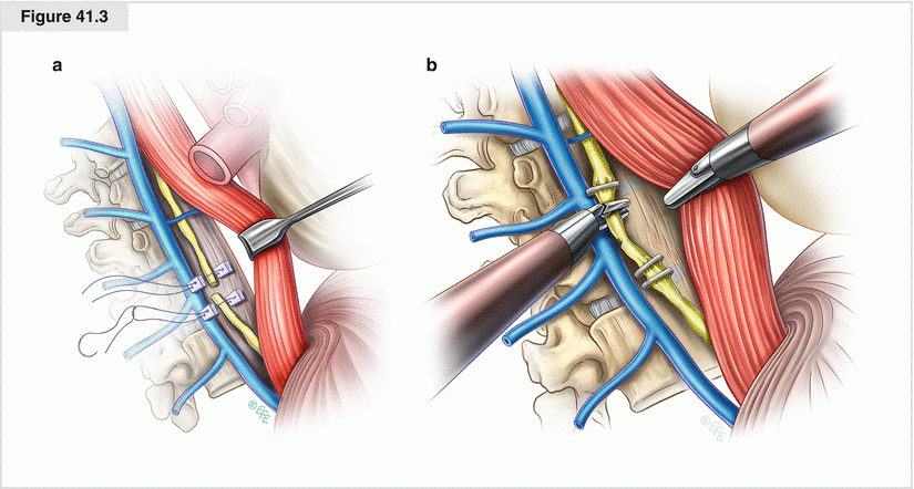 Chylothorax Thoracic Key