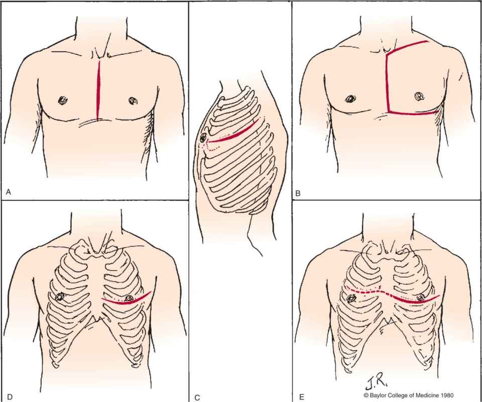 Trauma Thoracotomy Principles And Techniques Thoracic Key