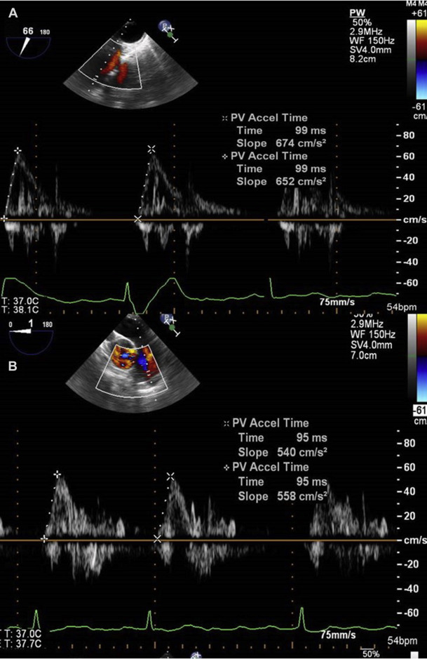 Transthoracic Echocardiography For Diagnosing Pulmonary Embolism A