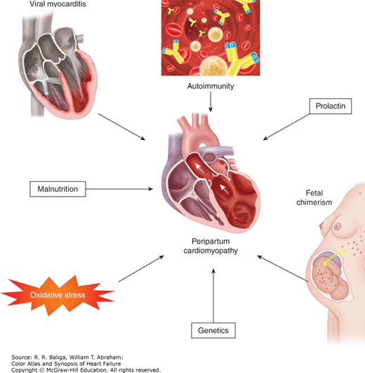 Peripartum Cardiomyopathy Thoracic Key